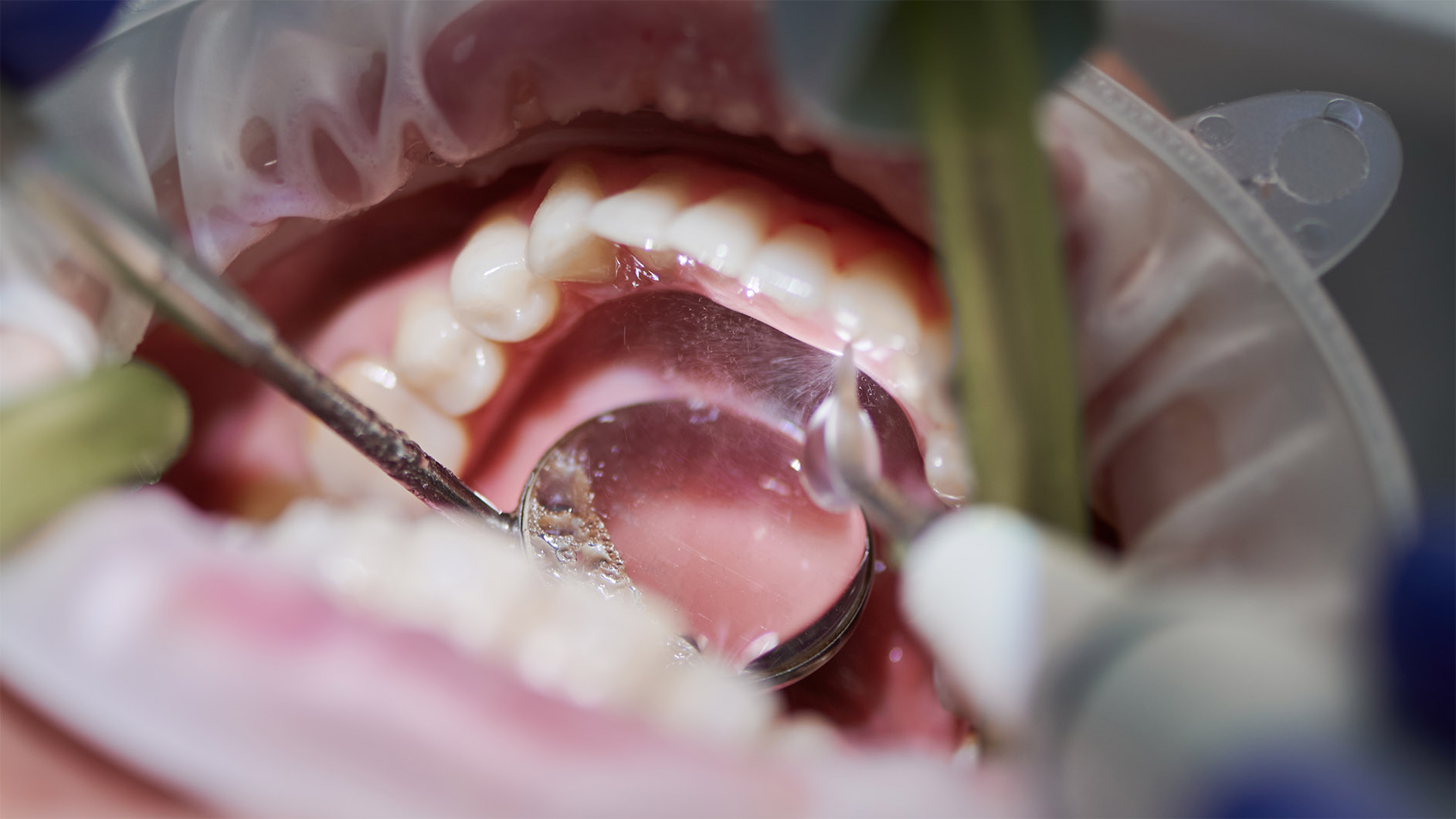 The Most Effective Ways to Get Rid of Tartar - HSmile Dental Clinic ...